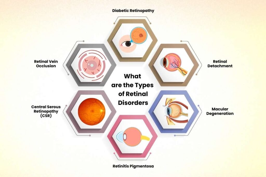 Types of Retinal Disorders: Causes, Symptoms, and Treatments | CyberPro ...