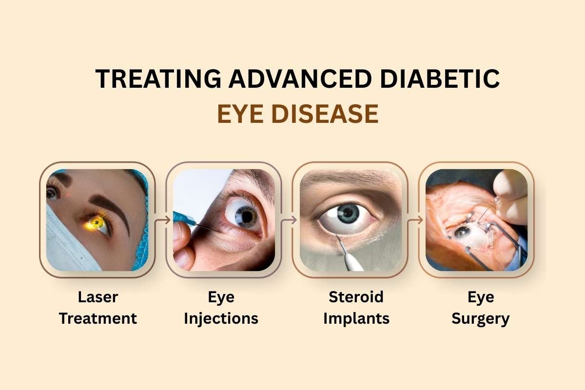 Diabetic Eye Disease: Symptoms, Treatments & Protection | Healthcare ...